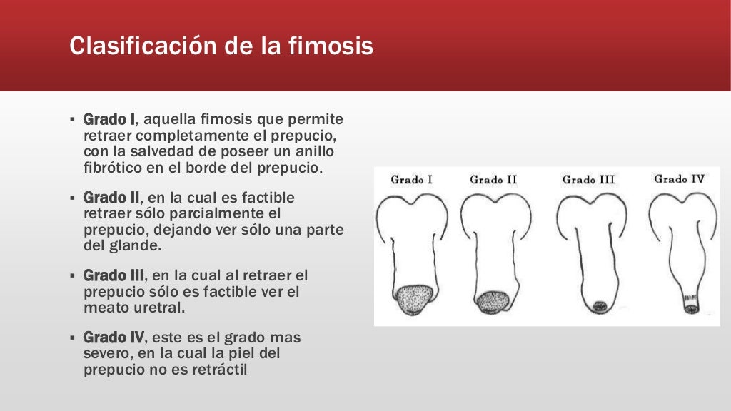 Fimosis en población pediátrica.