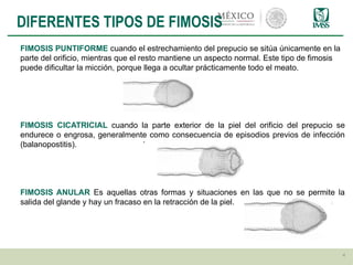FIMOSIS a quienes se les presenta...pptx