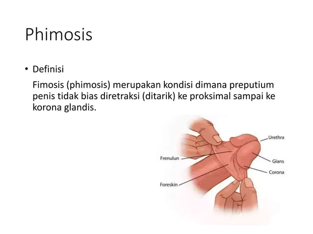 Fimosis dan Parafimosis | PDF