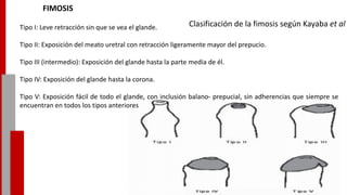 PATOLOGIAS UROLOGICAS: FIMOSIS Y PARAFIMOS.pdf