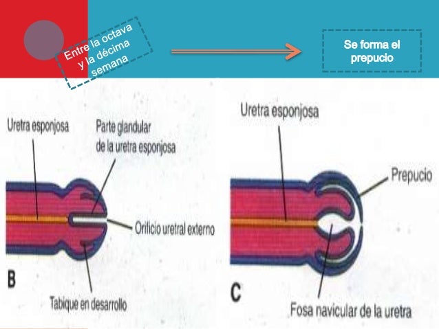 Fimosis y parafimosis