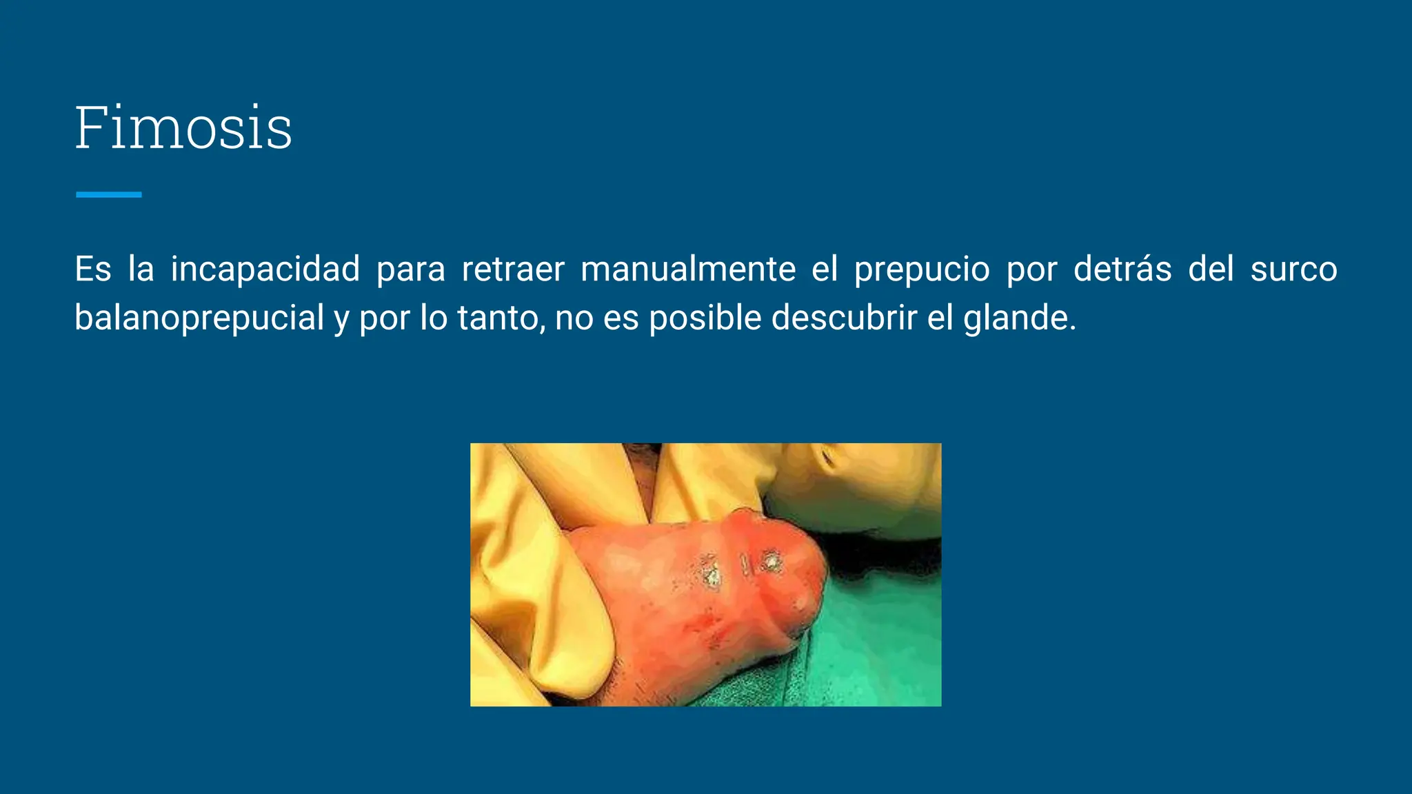 Fimosis y parafimosis;Clínica de urología | PPTX