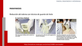 FIMOSIS Y PARAFIMOSIS. Medicina urologia | PPTX