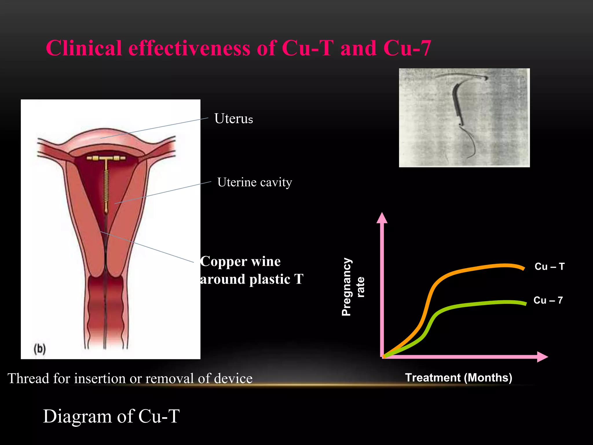 IUD | PPTX