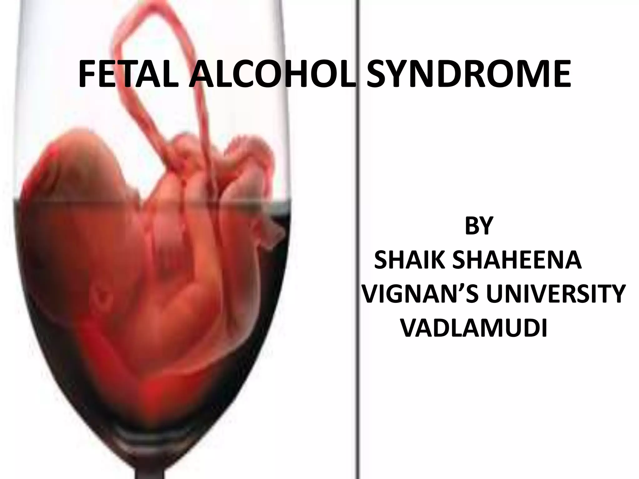 Fetal Alcohol Syndrome | PPT