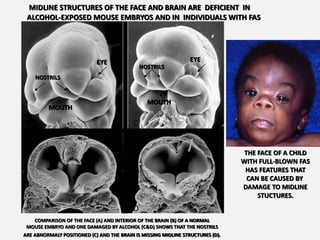 Fetal Alcohol Syndrome | PPTX