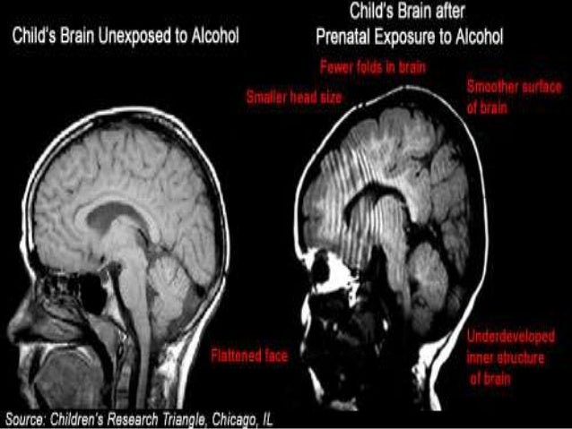 Fetal Alcohol Syndrome