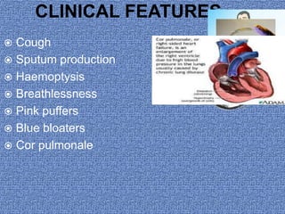COPD | PPTX