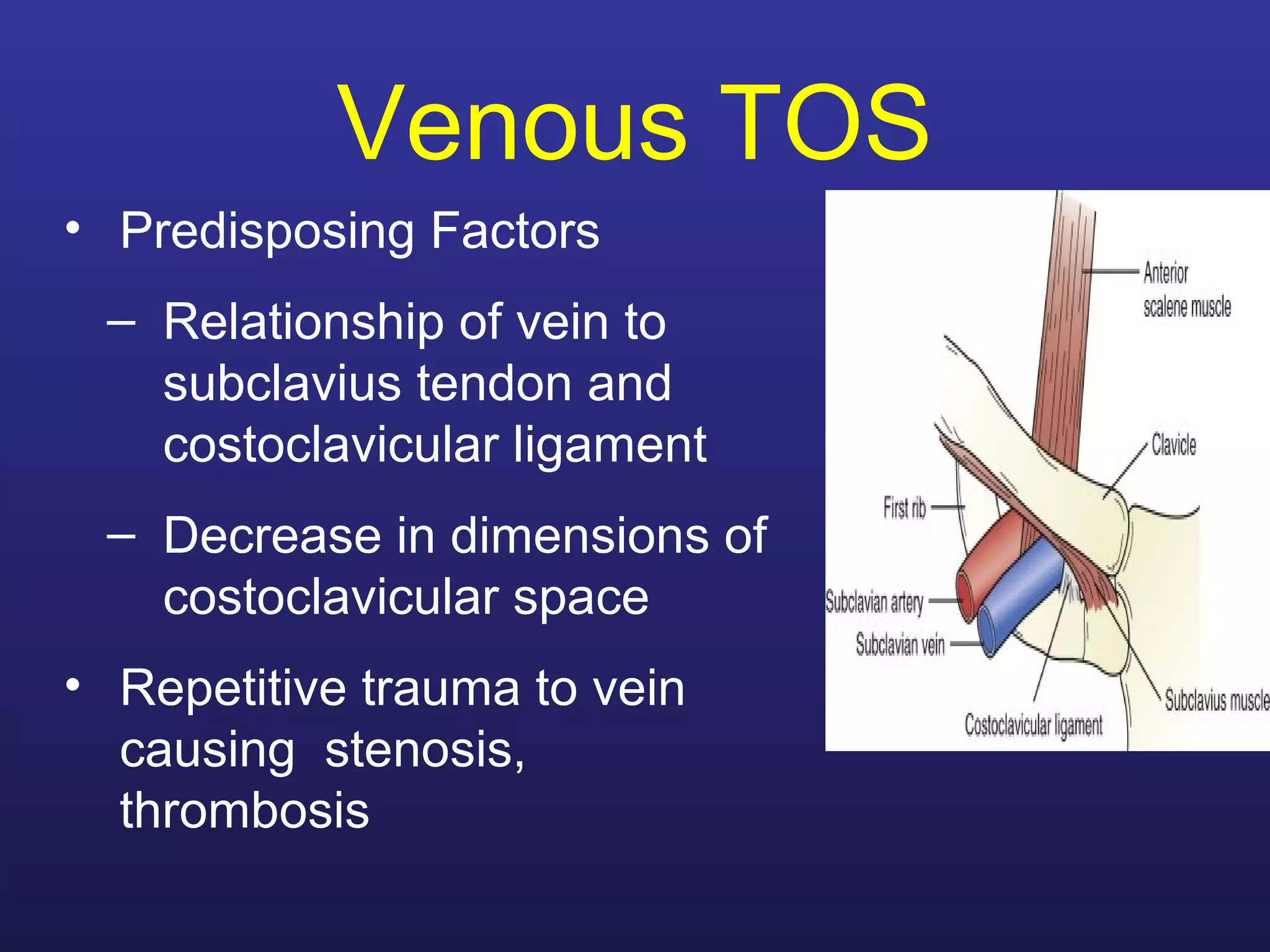 thoracic outlet syndrome | PPT