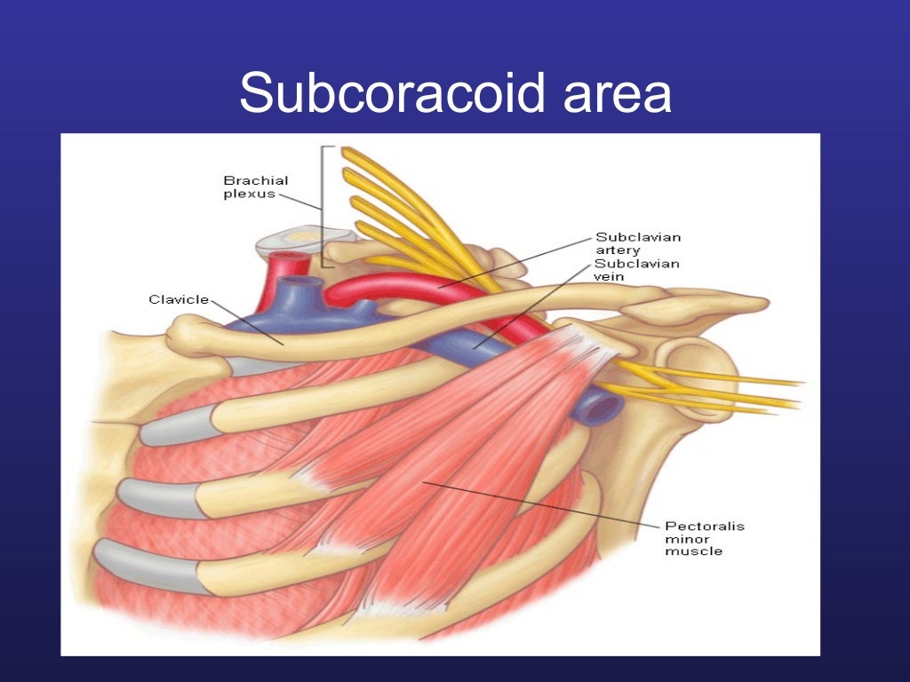 thoracic outlet syndrome