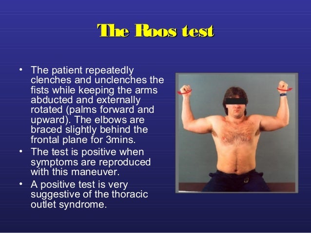 thoracic outlet syndrome
