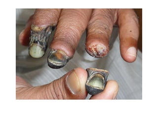 Gangrene & amputation | PPT