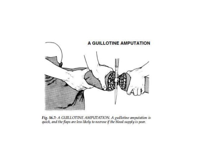 Gangrene Amputation
