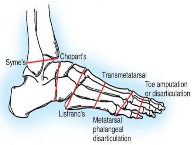 Gangrene & amputation