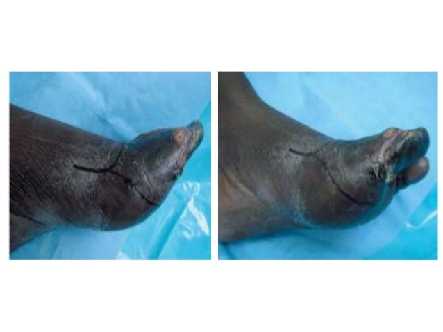 Gangrene & amputation