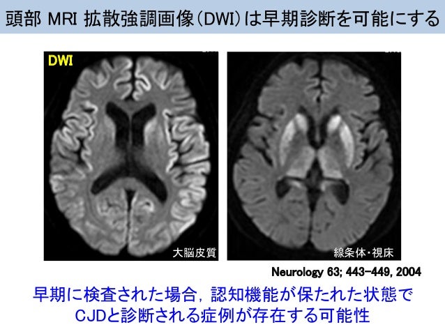 「クロイツフェルト・ヤコプ病における病名告知」