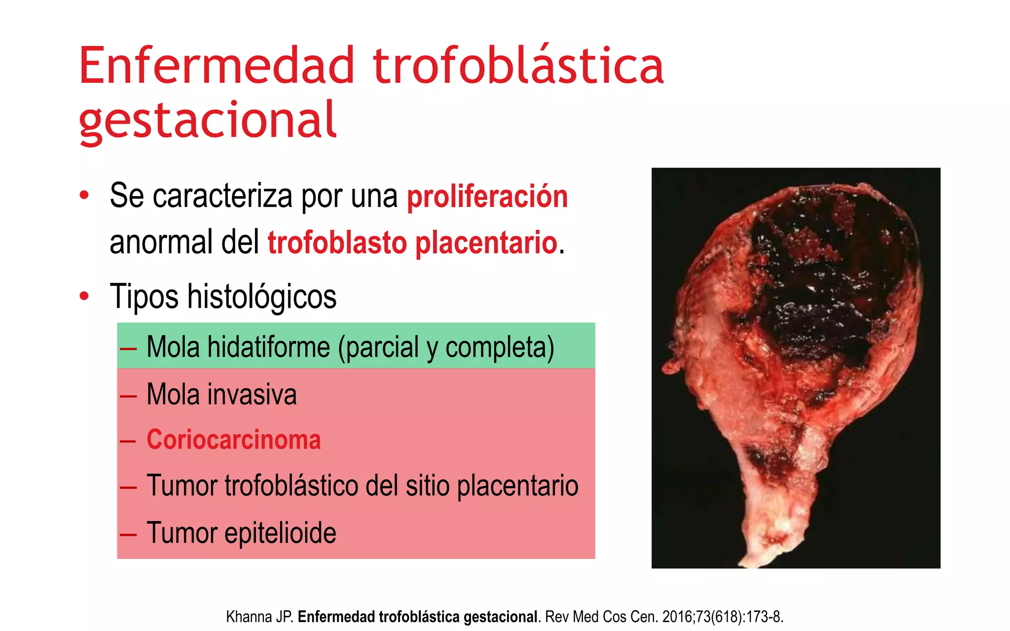 Coriocarcinoma, diagnóstico, seguimiento y tratamiento | PPTX