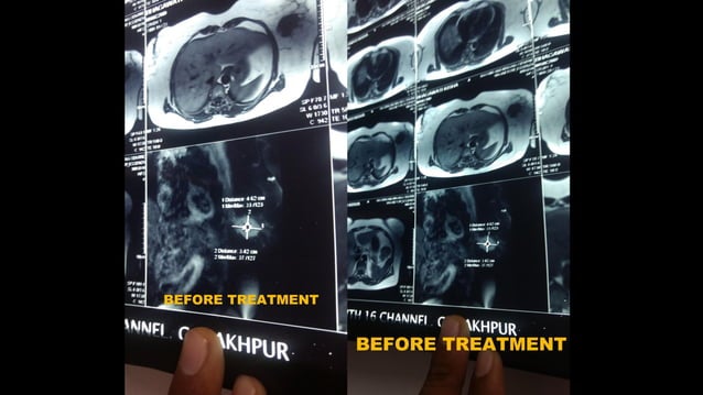 Breast Cancer & Homoeopathy | PDF