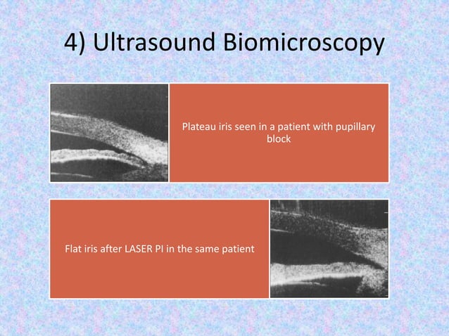 angle structure anatomy& IOP | PPTX