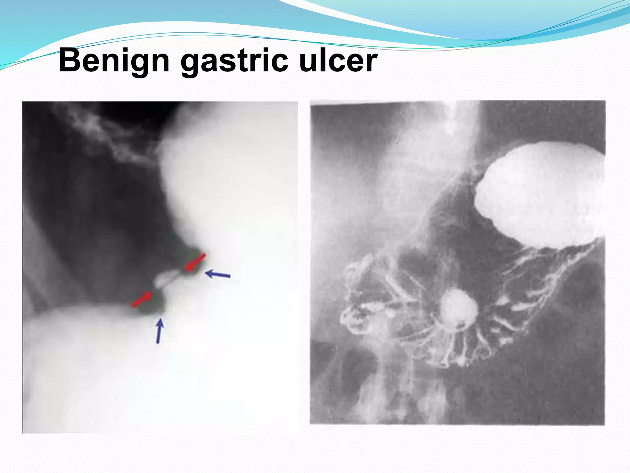 Radiological approach to gastric ulcer disease | PPTX