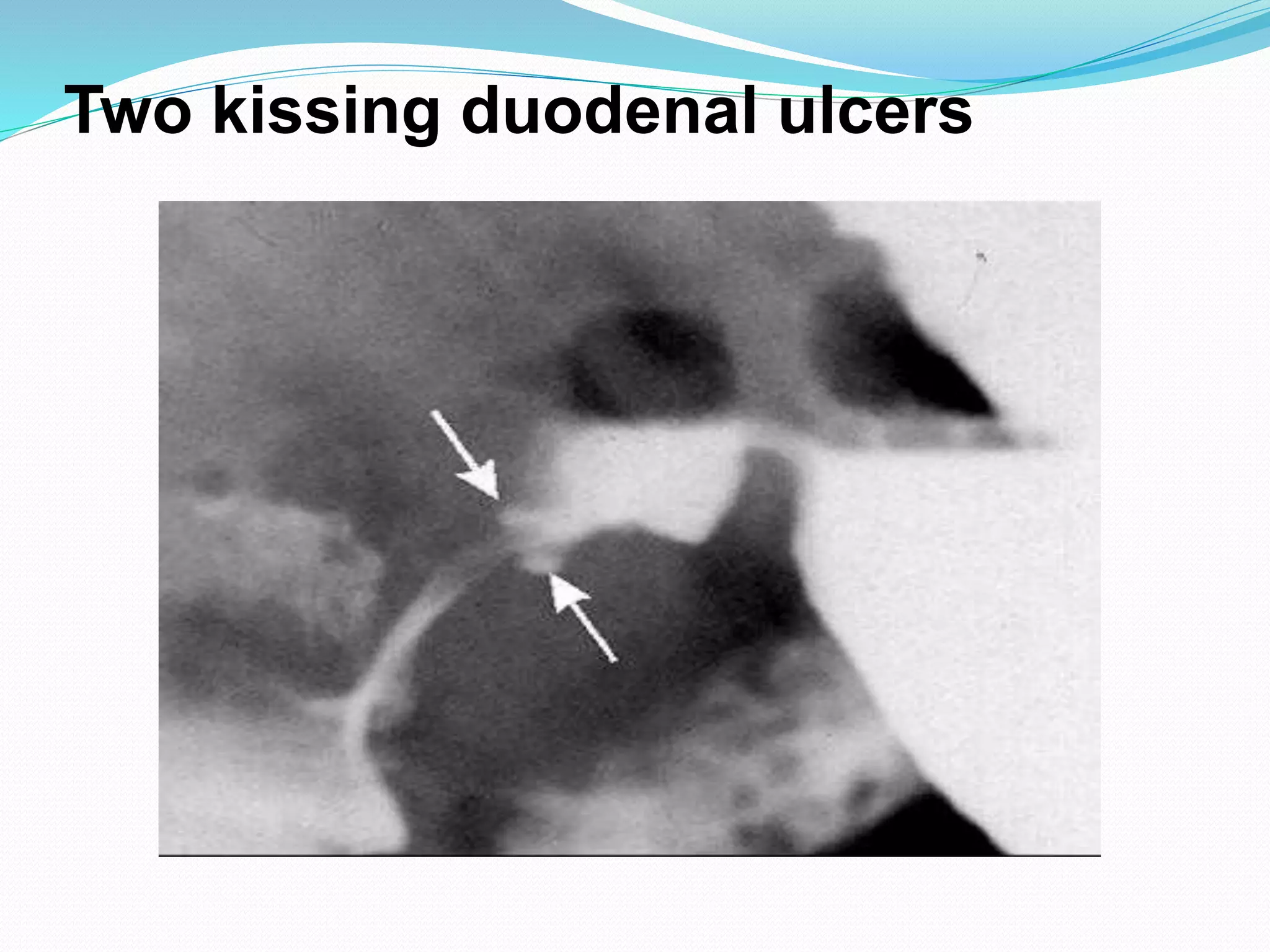 Radiological approach to gastric ulcer disease | PPTX