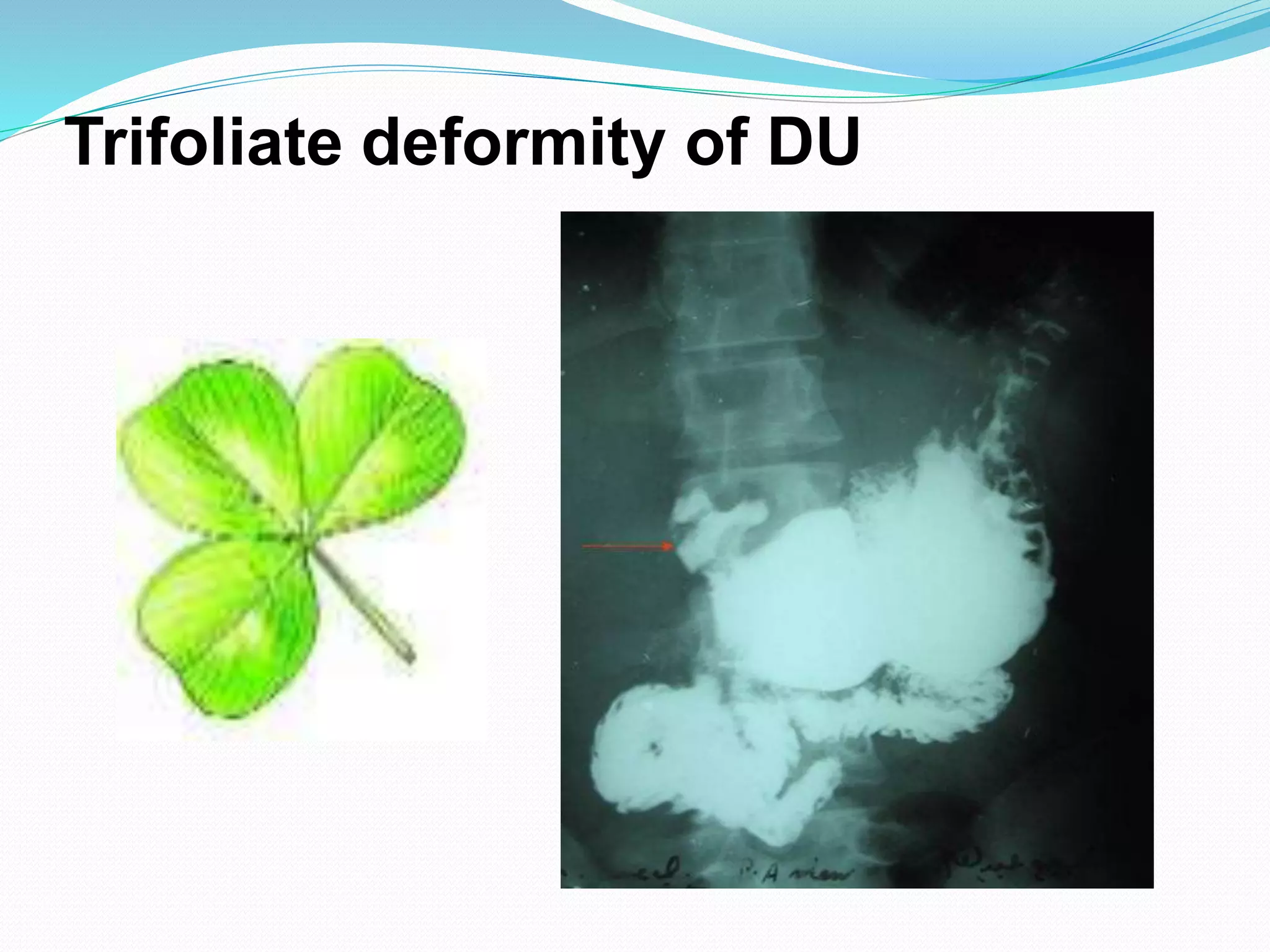 Radiological approach to gastric ulcer disease | PPTX