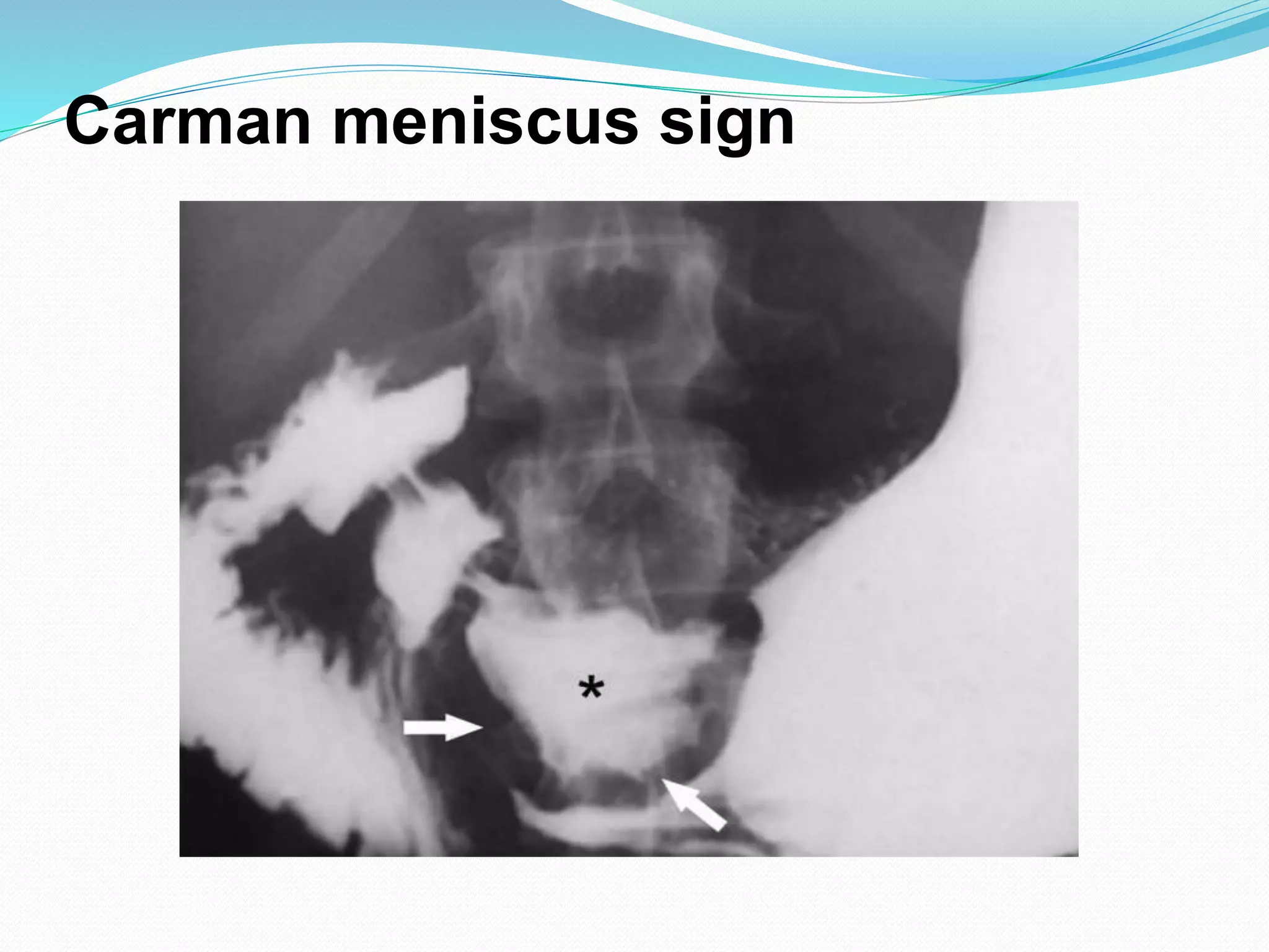 Radiological approach to gastric ulcer disease | PPTX