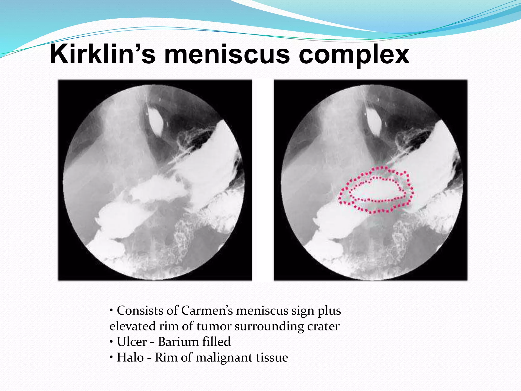 Radiological approach to gastric ulcer disease | PPTX