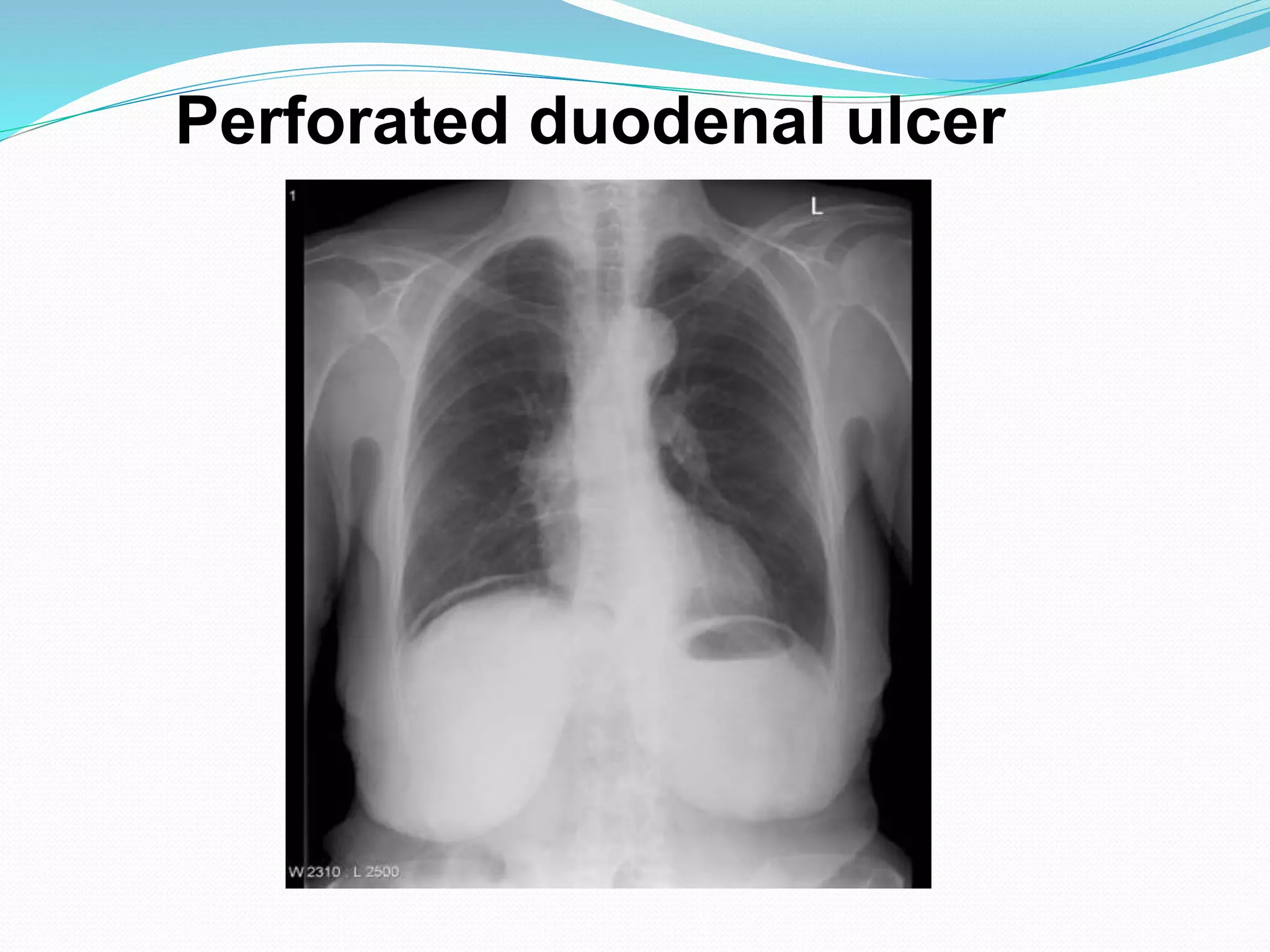 Radiological approach to gastric ulcer disease | PPTX