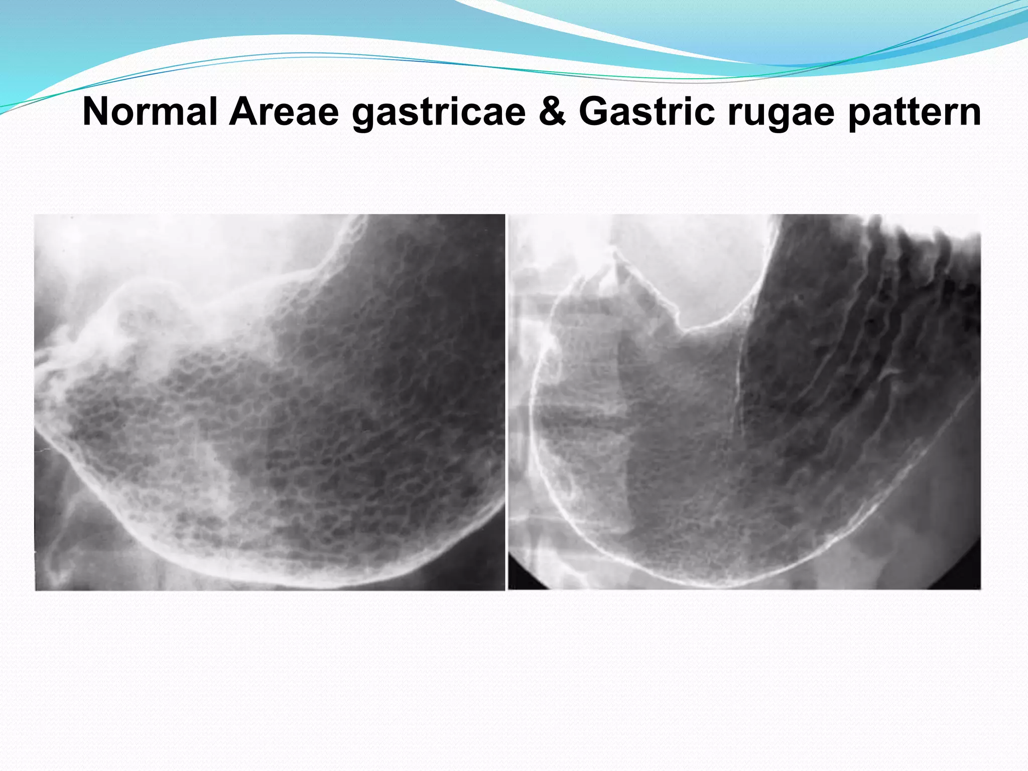 Radiological approach to gastric ulcer disease | PPTX