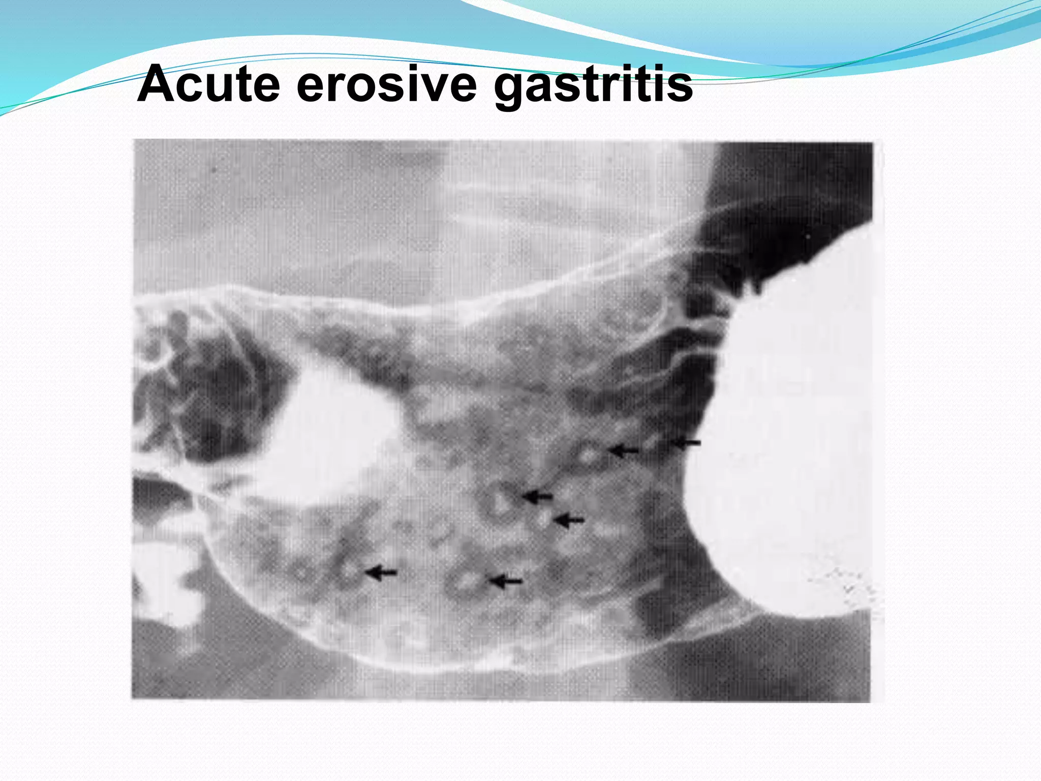 Radiological approach to gastric ulcer disease | PPTX