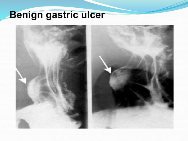 Radiological approach to gastric ulcer disease | PPTX | Digestive ...