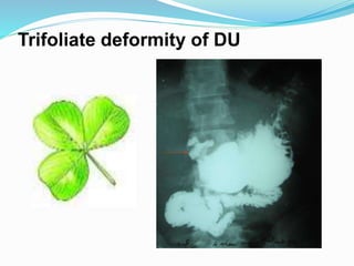 Radiological approach to gastric ulcer disease | PPTX