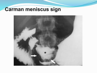 Radiological approach to gastric ulcer disease | PPTX