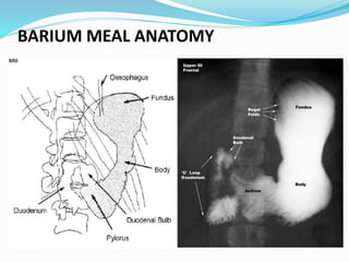 Radiological approach to gastric ulcer disease | PPTX