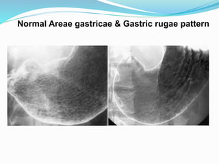 Radiological approach to gastric ulcer disease | PPTX