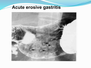 Radiological approach to gastric ulcer disease | PPTX