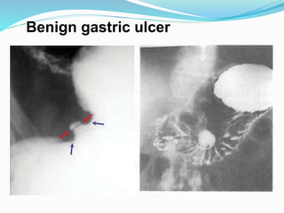Stomach Ulcer X Ray