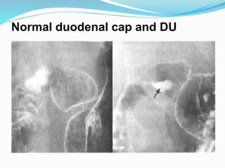 Duodenal Ulcer X Ray