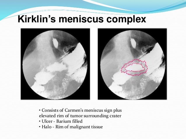 Radiological approach to gastric ulcer disease