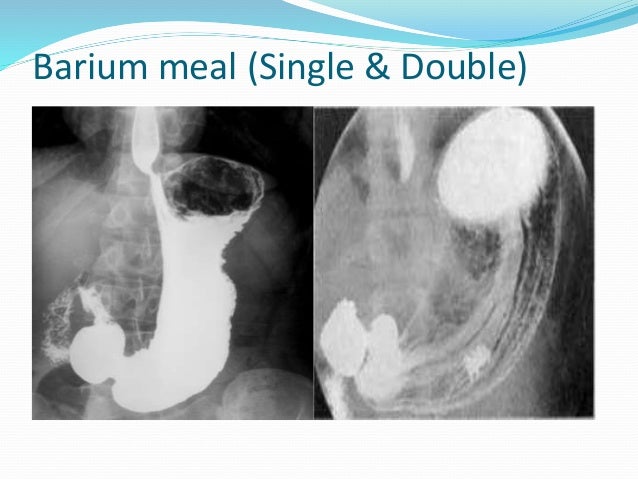 Radiological approach to gastric ulcer disease