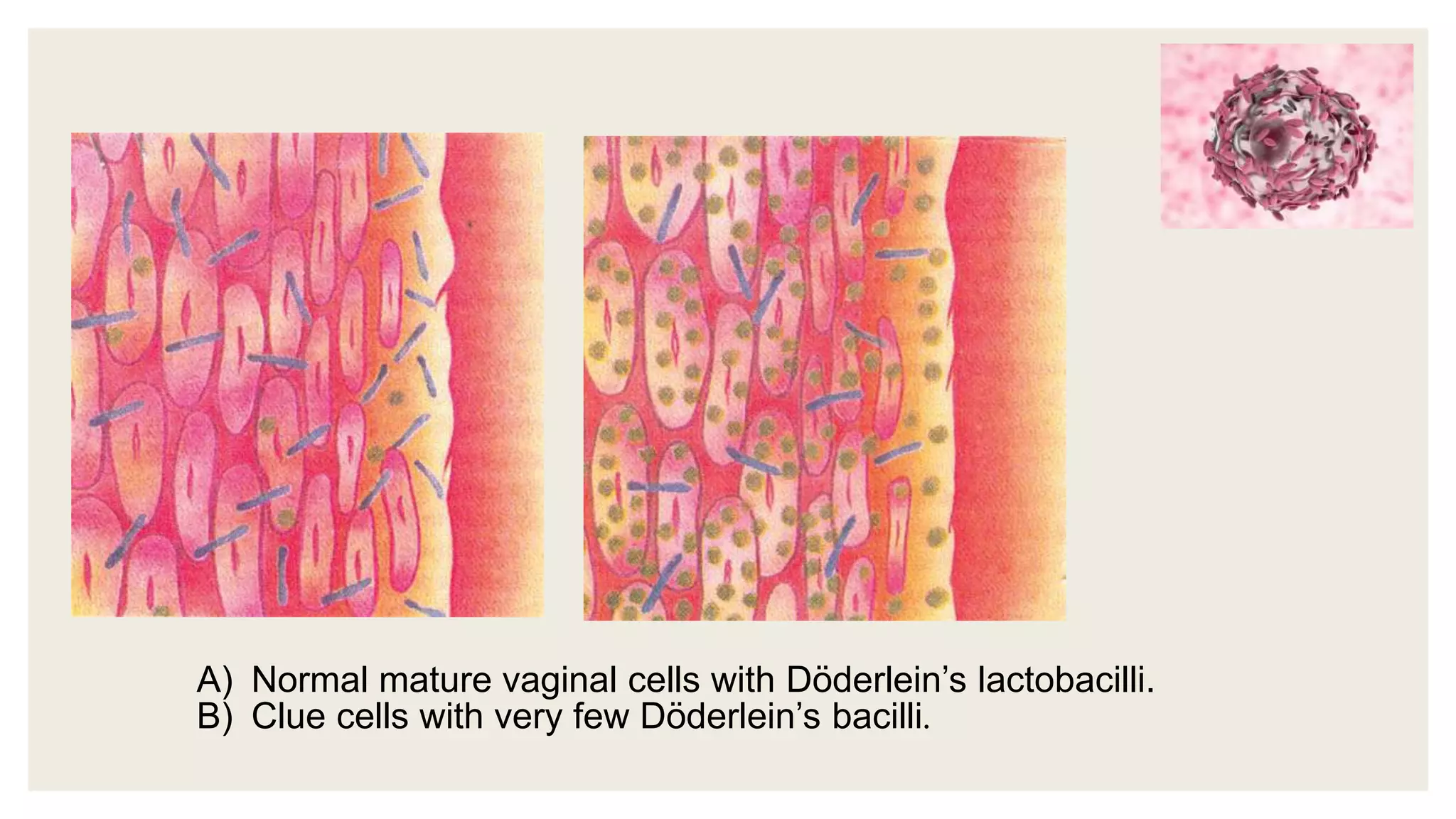 most common causes of infectious vaginitis.pptx