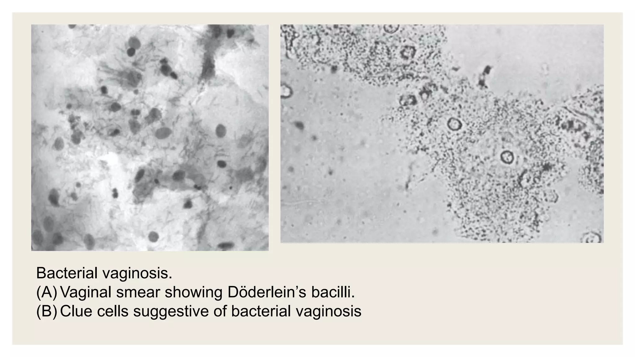 most common causes of infectious vaginitis.pptx