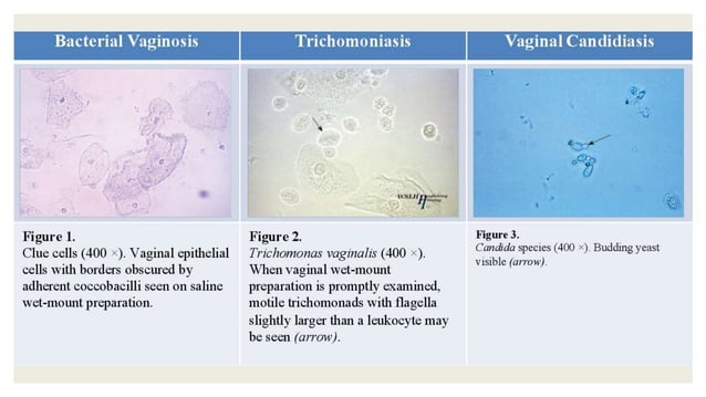 most common causes of infectious vaginitis.pptx