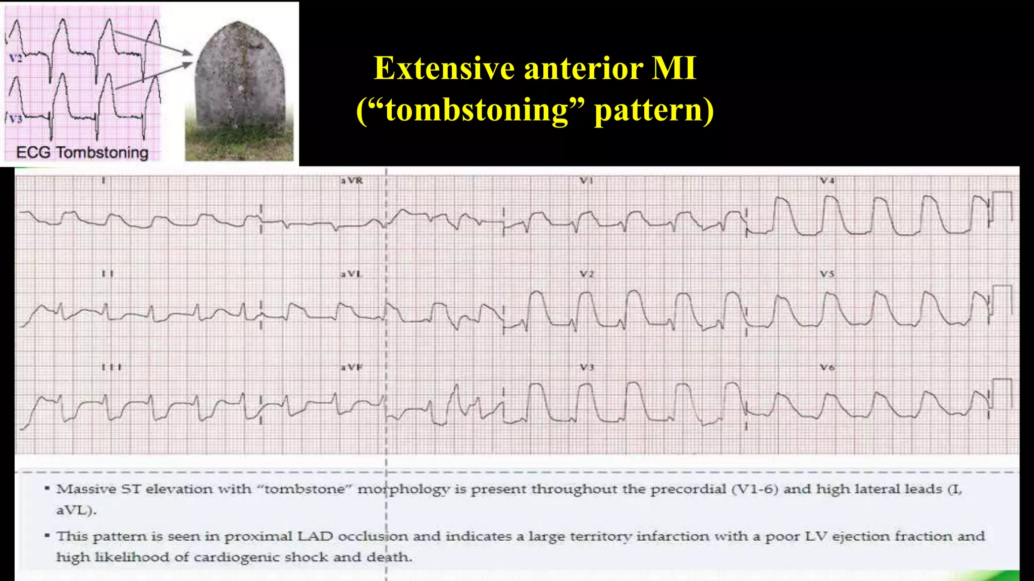 ECG DIAGNOSIS OF ACUTE CORONARY SYNDROME.pptx