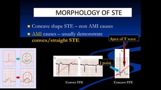 ECG DIAGNOSIS OF ACUTE CORONARY SYNDROME.pptx
