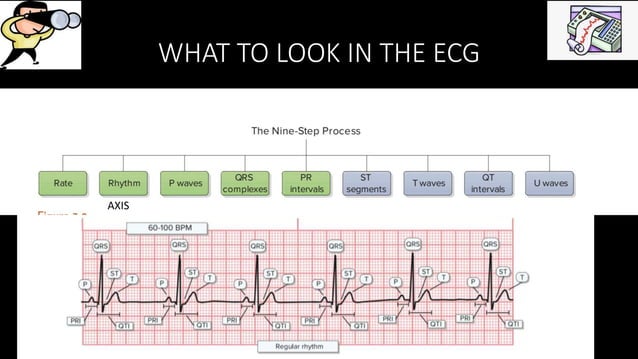 ECG DIAGNOSIS OF ACUTE CORONARY SYNDROME.pptx
