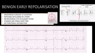 ECG DIAGNOSIS OF ACUTE CORONARY SYNDROME.pptx