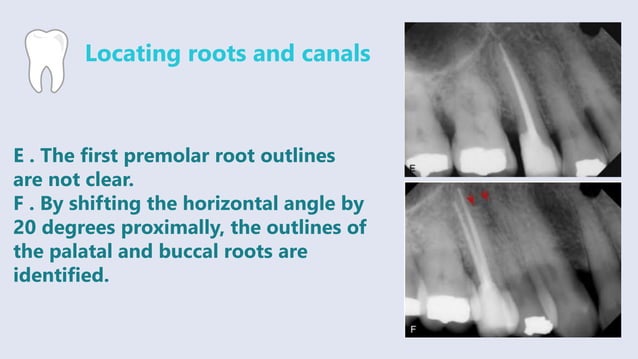 X-rays uses and benefits in endodontic treatment | PPTX