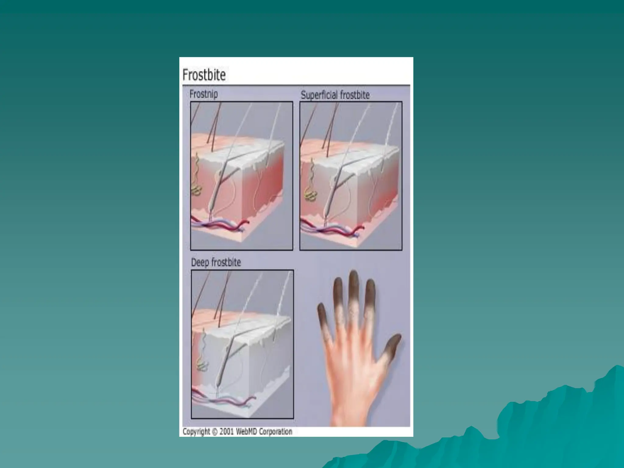 COLD INJURIES: DESCRIPTION, TREATMENT AND PREVENTION | PPT